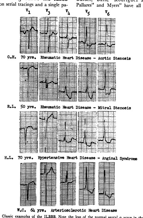 Figure 1 From The Incomplete Left Bundle Branch Block Semantic Scholar