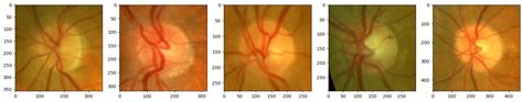 GitHub WojciechMojsiejuk EXPLAINABILITY AND GENERALIZABILITY OF GLAUCOMA DETECTION MODELS