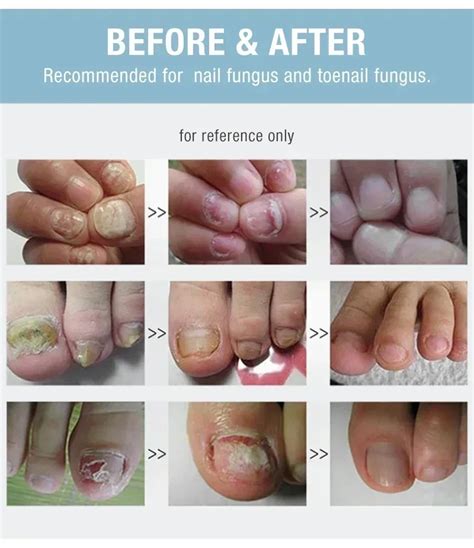 Сыворотка для лечения грибка ногтей восстановление ног жидкий гель для удаления грибка ногтей