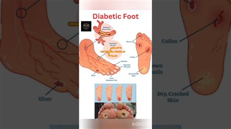 Recognizing Diabetic Foot Causes And Warning Signs Viralshorts