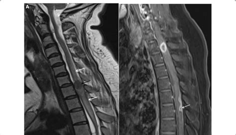 Intramedullary Tuberculoma In A 35 Year Old Female With Pulmonary