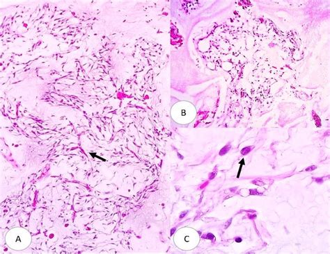 A Liposarcoma Micrograph 10x Hematoxylin Eosin H And E Staining