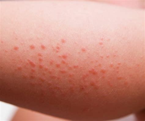 Candida Rash • Dumb Little Man