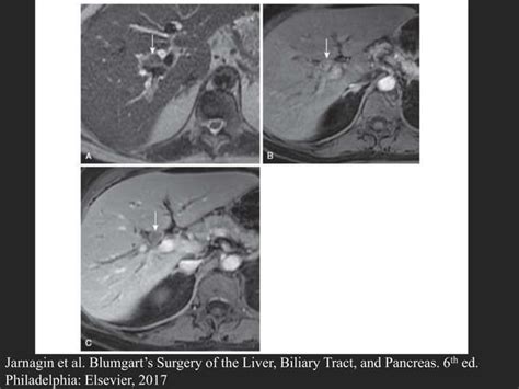 Hilar Cholangiocarcinoma In My Point Of View Pptx