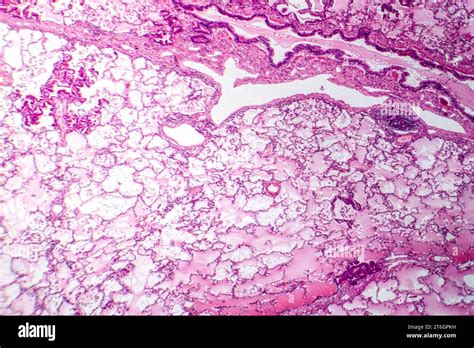 Photomicrograph Of Lung Adenocarcinoma Displaying Malignant Glandular Cells Indicative Of The