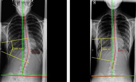 Scoliosis Treatment Case Study 15 Year Old Female 32° Curve Correct