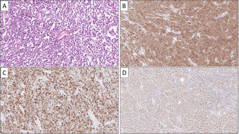 Metastatic Merkel Cell Carcinoma Mcc Note The Small Blue Round Cell
