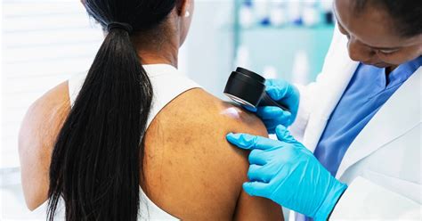 Five Crucial Signs Your Mole Might Be A Melanoma Oncologist Says