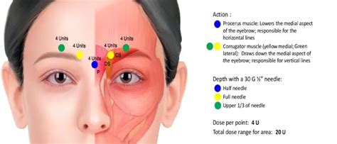 How To Treat The Glabellar Frown Lines Using Botox