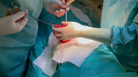 Loop Colostomy Reversal