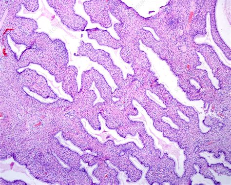 Human Endocervical Polyp Light Micrograph Stock Image C061 3393 Science Photo Library