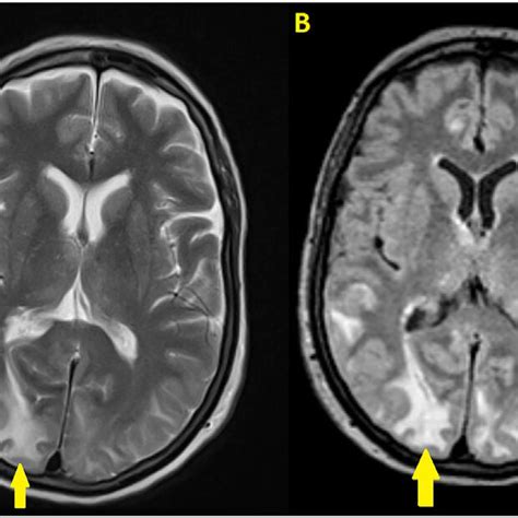 Magnetic Resonance Imaging Of Brain With Contrast Demonstrating Diffuse Download Scientific