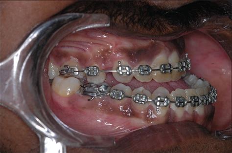 Dental Relationship After Orthodontic Decompensation Exaggerated
