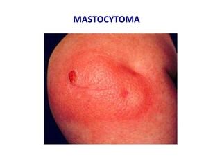 Mastocytosis Cutaneous And Systemic Pptx