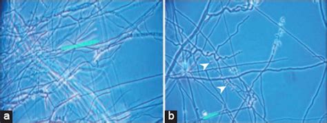 Tinea Cruris Microscope