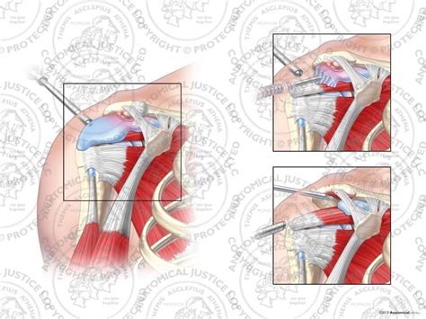 Right Acromioplasty With Partial Bursectomy No Text Stock Medical
