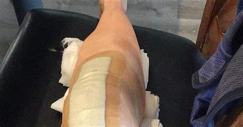 Total Knee Replacement Day 1 Album On Imgur