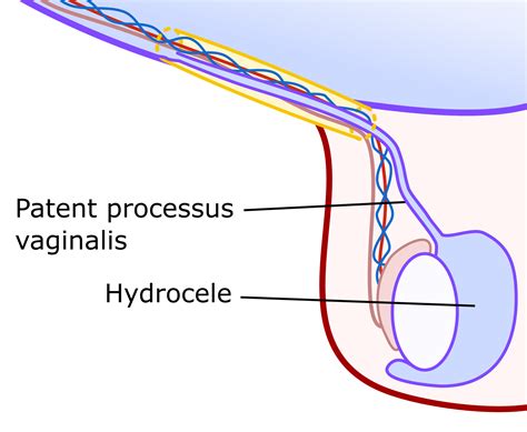 Hydrocele Scrotal Lump Geeky Medics