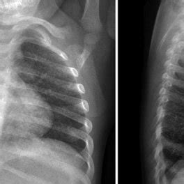 Thoracic Computed Tomography Scan Diffuse Bilateral Micronodular Download Scientific Diagram