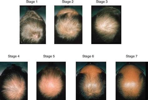 What Are The Different Types Of Male Pattern Baldness Free Math