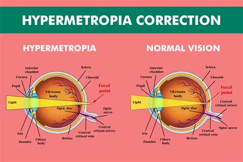 Hypermetropia Causes Symptoms And Treatment Laxmi Eye Hospital