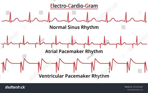 Set Ecg Common Abnormalities Atrial Vs Stock Vector Royalty Free 2412070987 Shutterstock