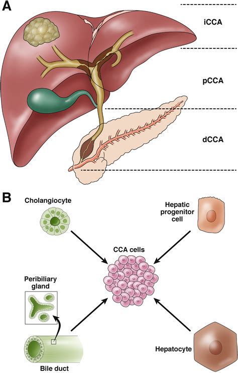 Pathogenesis Diagnosis And Management Of Cholangiocarcinoma Gastroenterology Pathogenesis Diagnosis And Management Of Cholangiocarcinoma Gastroenterology