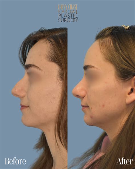 Patient 272817 Rhinoplasty Before And After Photos Chevy Chase Facial Plastic Surgery
