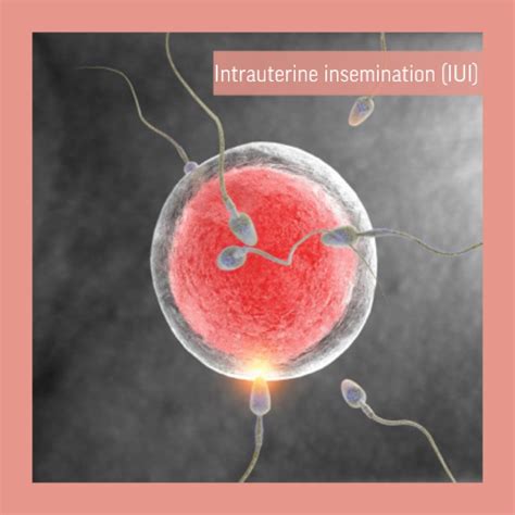 Intrauterine Insemination Iui Plusmed Fertility Agency