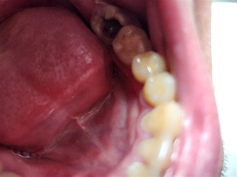 어금니 깨짐 지식in