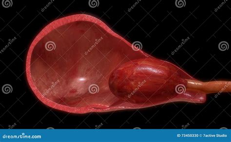 Het Trekken Van Moederkoek Uit Baarmoeder Stock Foto Image Of Vlees Biologie 73450330