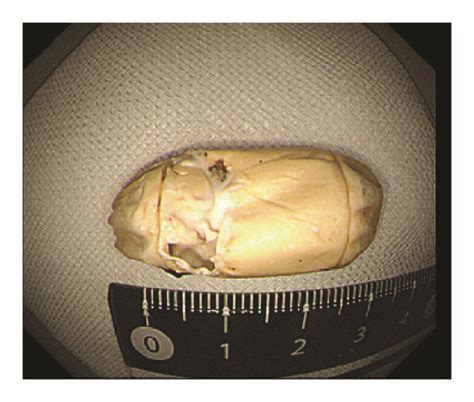 The Patency Capsule Was Collected From The Colon By Colonoscopy