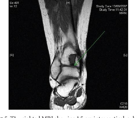 Figure 2 From Intraosseous Ganglion Of The Distal Tibia Clinical Radiological And Operative