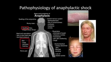 What Is The Cause Of Anaphylactic Shock At Ilene Haase Blog