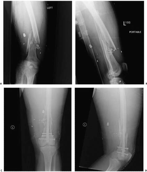 Orif Three Part Fracture Of The Proximal Humerus TeachMe Orthopedics