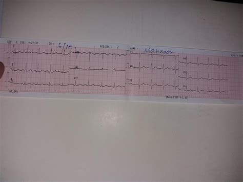 Is It Possible For A Pvc To Immediately Follow A Pac Recg