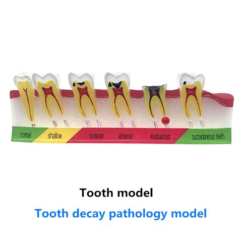 Caries Classification