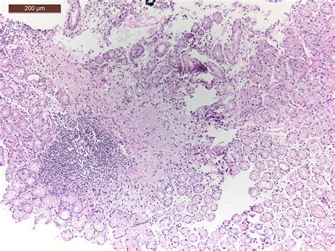 Pathology Outlines Diffuse Poorly Cohesive Type Adenocarcinoma
