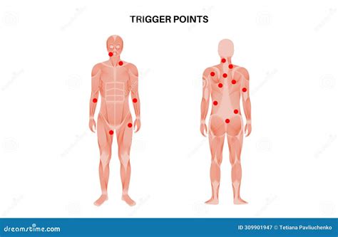 Myofascial Trigger Points Stock Vector Illustration Of Stress 309901947