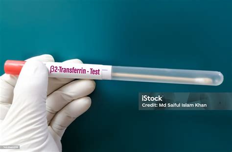 Nasal Fluid Sample Beta 2 Transferrin Test For The Diagnosis Of Csf