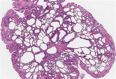 Your Pathology Report For Hyperplastic Polyp Of The Stomach
