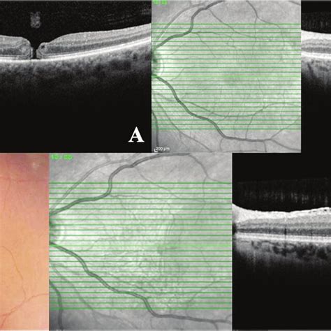 Case 3 Ab Infrared Retinal Images And Spectral Domain Optical