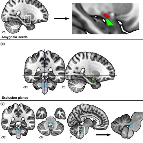 Seeds Used For Tractography Group Map For The Trigeminal Motor Nucleus