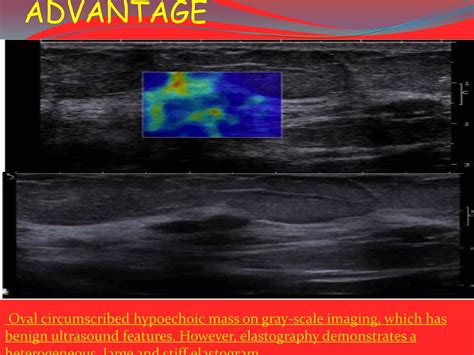Elastography Pptx
