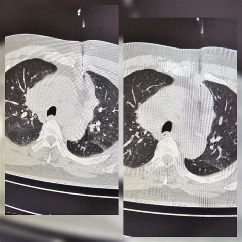 Amro Kabakbjy On Linkedin Complex Lymph Node Biopsy