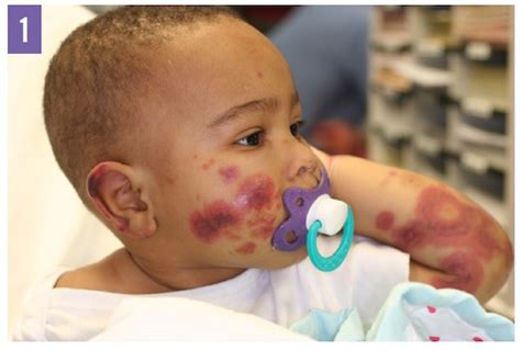 Interactive Quiz Rash In An Infant Consultant