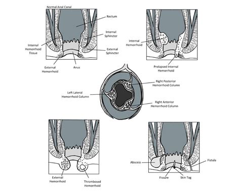 Thrombosed Hemorrhoid Vs Perianal Hematoma At Henry Briggs Blog