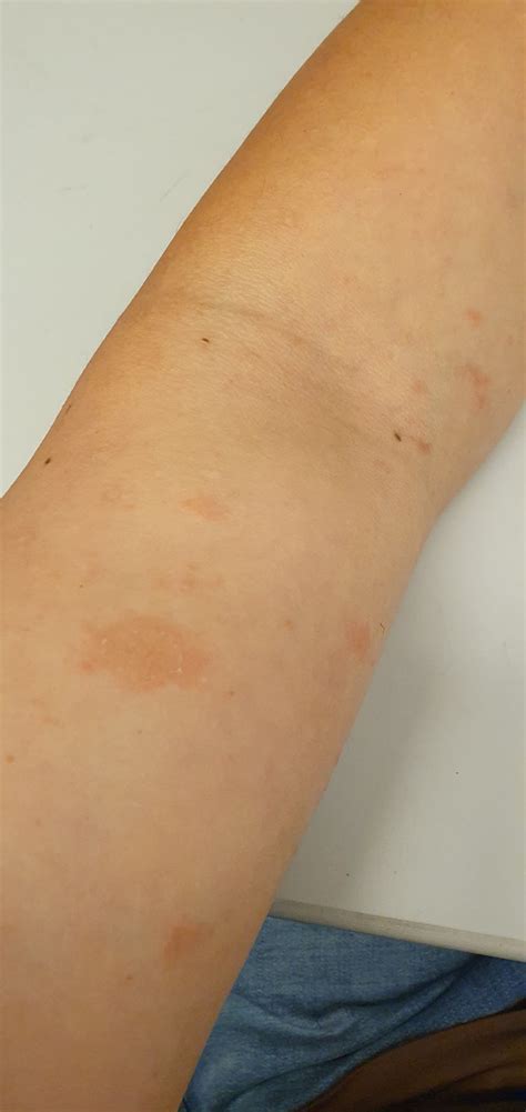 팔 붉은반점이 갑자기 생겼어요 지식in