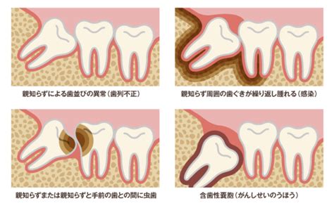 抜歯のギモンについて 親知らずについての質問に答えます 登戸川崎市多摩区 登戸グリーン歯科矯正歯科
