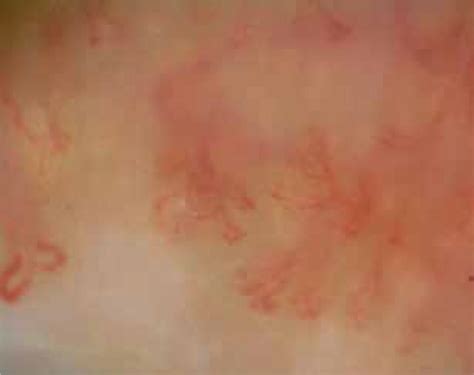 The Usefulness Of Nailfold Capillaroscopy In Scleroderma Spectrum